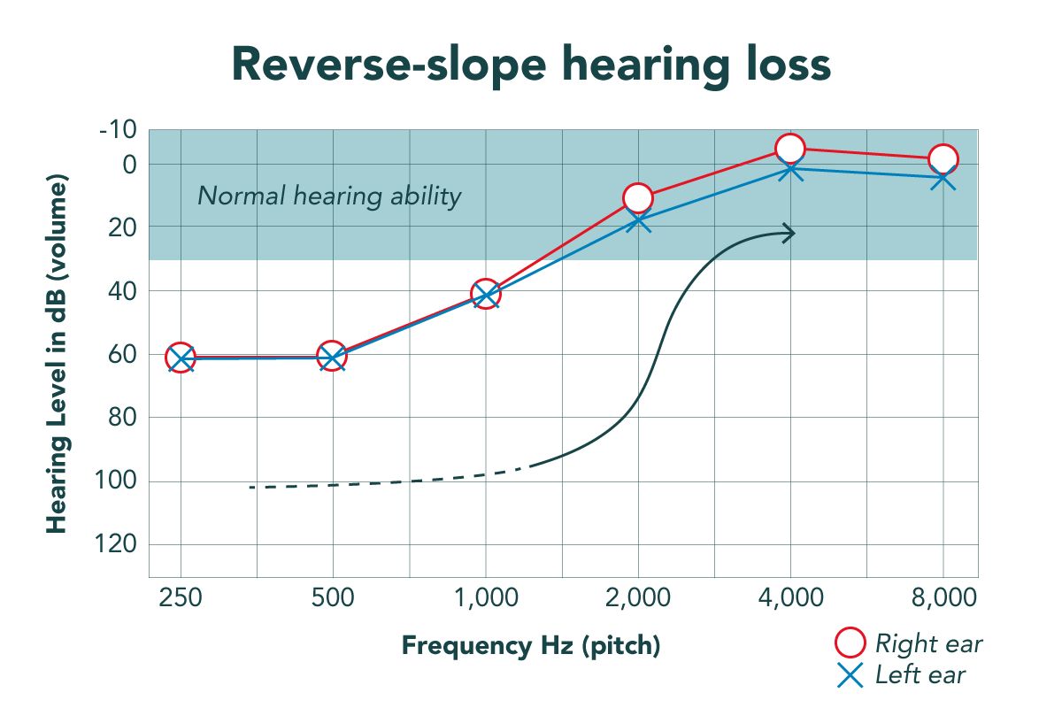 What is low-frequency hearing loss? Causes & cure | Miracle-Ear